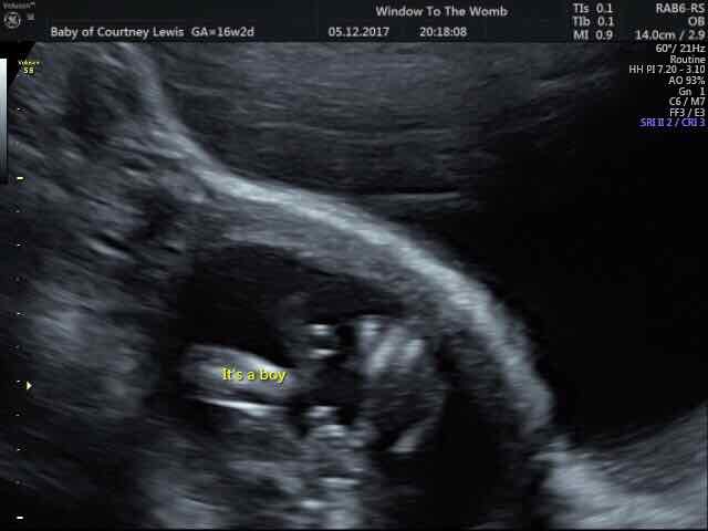 Has anyone ever had the the Window to the Womb gender scan? And was it ...