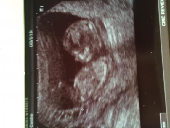 Absent nasal bone? 12 week scan