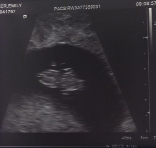 Any 9 week scan pictures?