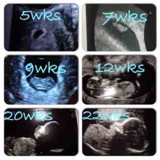 empty gestational sac - hiccups pregnancy