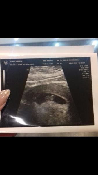 8 Weeks Scans - Can i see your pictures please | Netmums