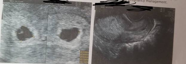 5 +4 bloot clots and blood.. Am I miscarrying?