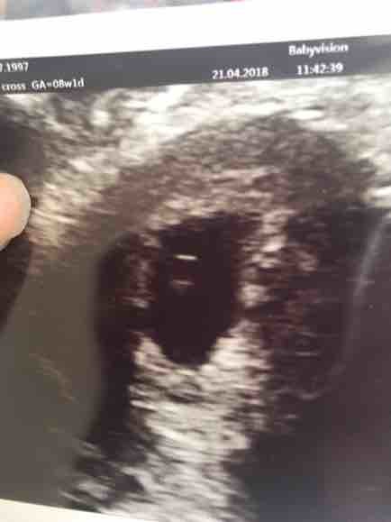 Early Pregnancy Scan at 5 weeks but empty sac
