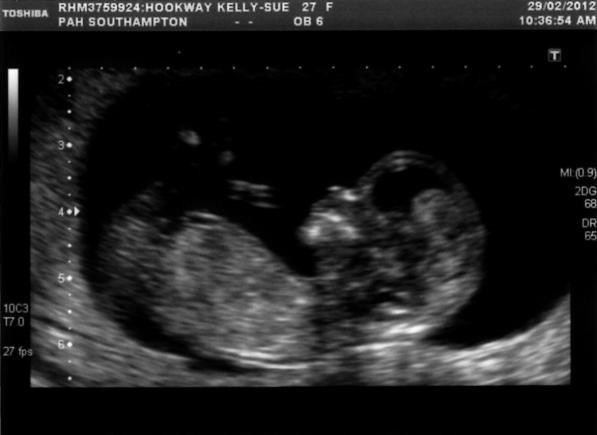 Nub theory - 14 week scan picture can you help?