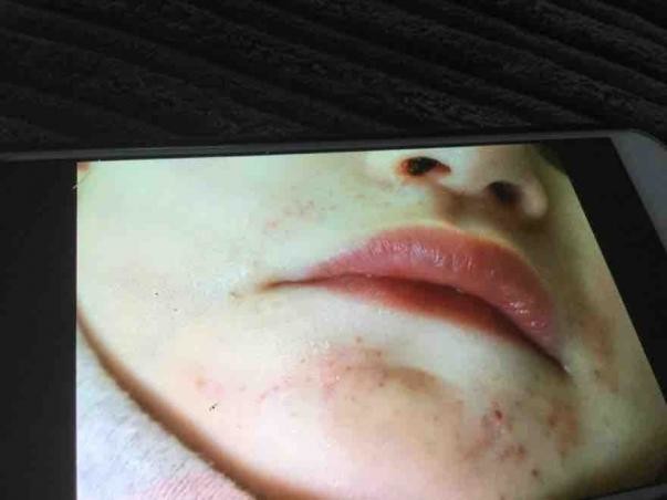 23 Month old little girl red pinprick rash which doesn't disappear.