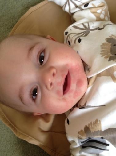 Red Rash Around Lips Child | Lipstutorial.org