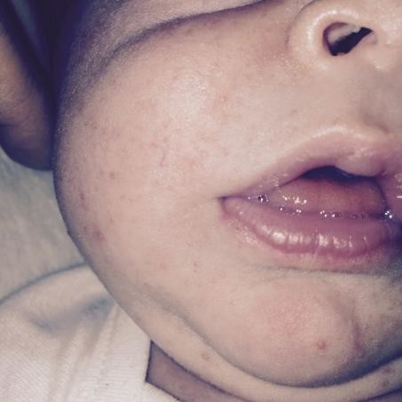 Why Do Babies Get Blisters On Their Lips | Lipstutorial.org