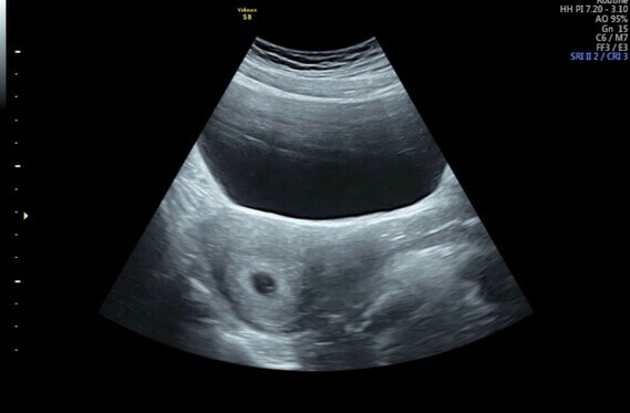 went for a scan thinking I was 6 weeks....