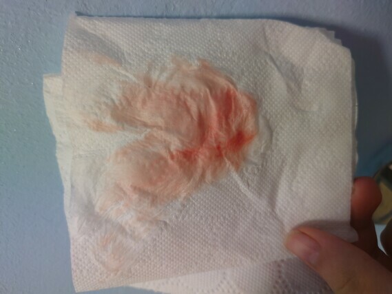 Implantation bleeding (TMI PHOTOS)